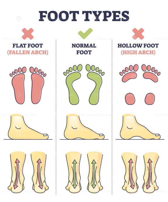 Cavus foot with abnormal high arch condition to feet bones outline ...