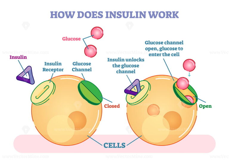 Type 2 diabetes and insulin resistance anatomical explanation outline ...