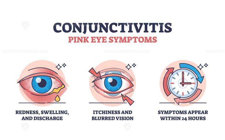 Conjunctivitis treatment for bacterial and allergic type outline ...
