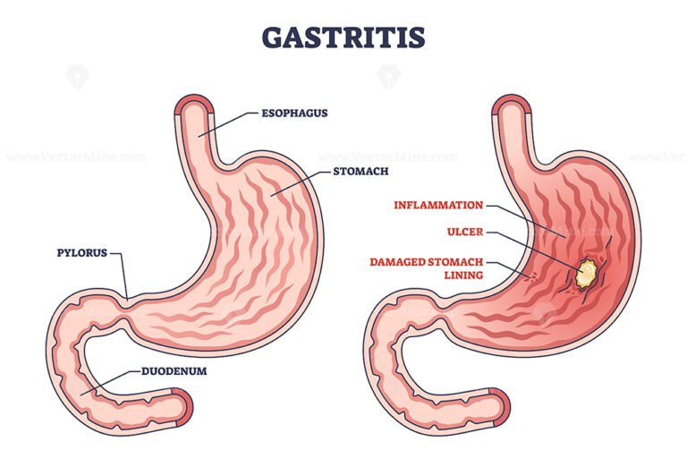 Cholecystitis as gallbladder inflammation from gallbladder outline diagram – VectorMine