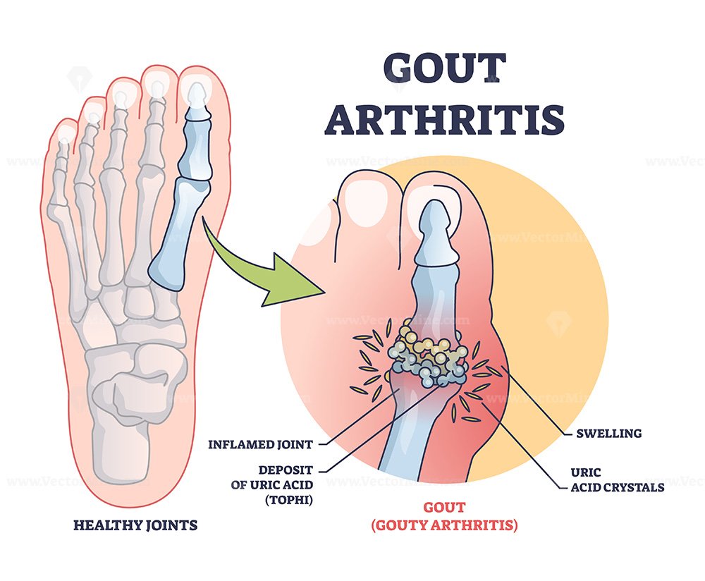 Autoimmune activity in rheumatoid arthritis skeletal disease outline ...