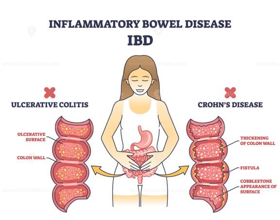 Crohns Disease Symptoms From Inflammatory Bowel Illness Outline Diagram